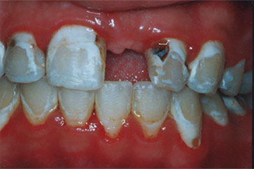 Risks and Benefits | Ayrshire Orthodontics